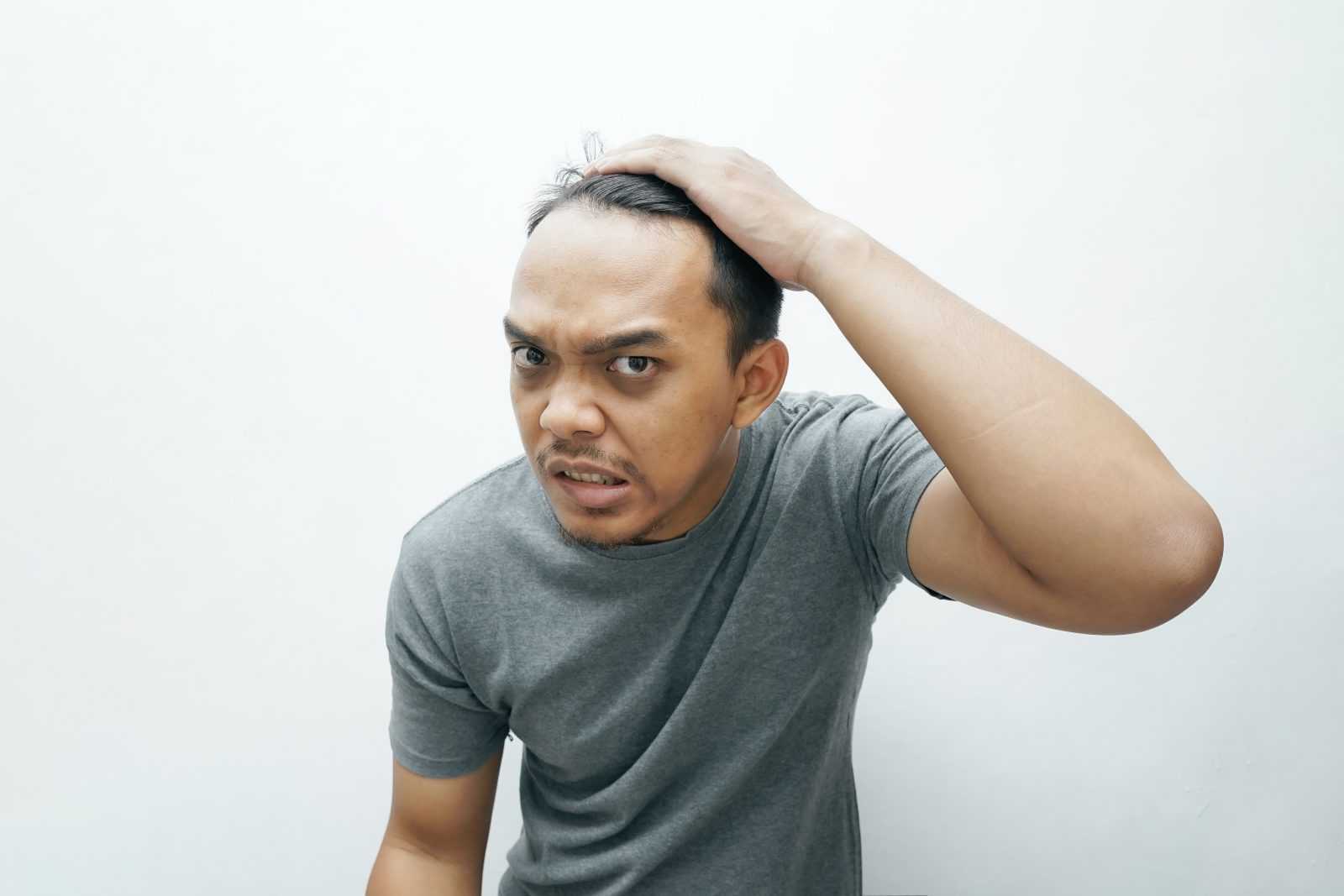 Does Low Testosterone Cause Hair Loss? Everything You Need to Know