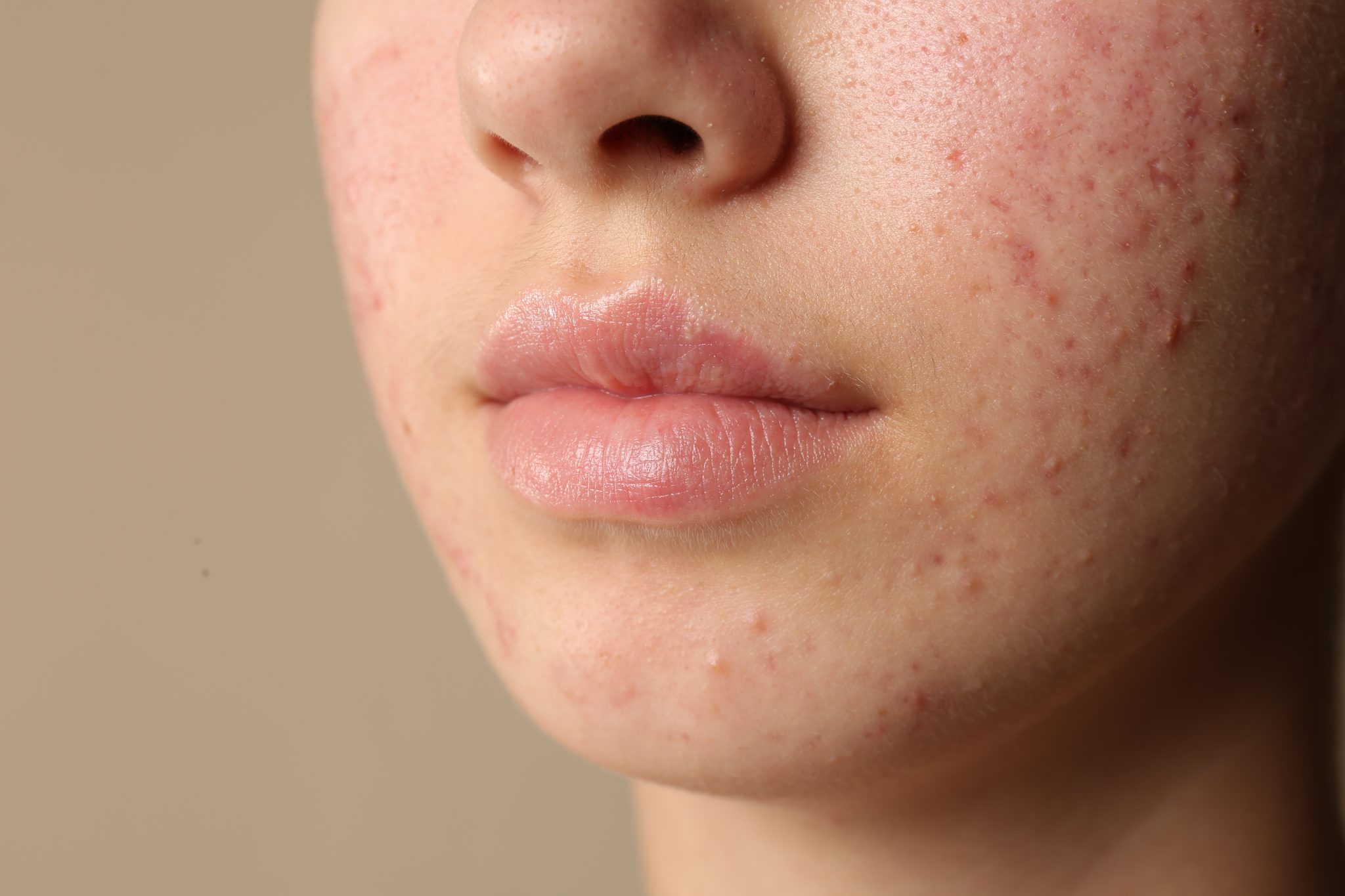 TRT and Skin Health: Why Acne Happens and How to Prevent It