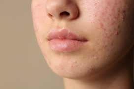 TRT and Skin Health: Why Acne Happens and How to Prevent It