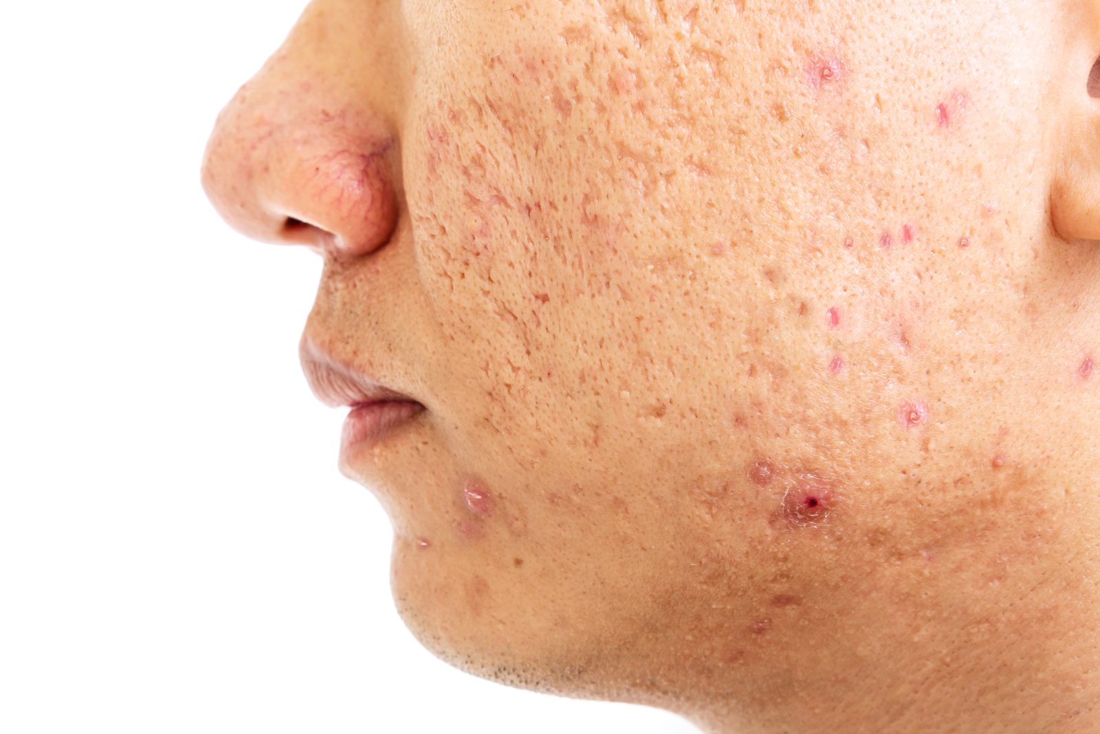 TRT and Skin Health: Why Acne Happens and How to Prevent It