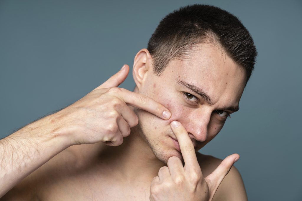 TRT and Skin Health: Why Acne Happens and How to Prevent It