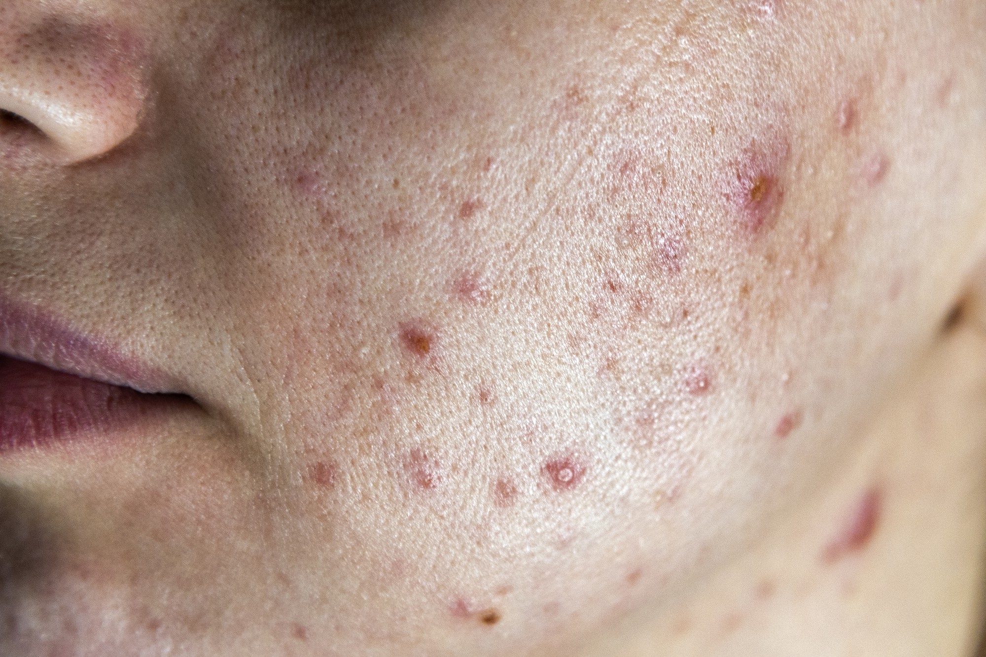 TRT and Skin Health: Why Acne Happens and How to Prevent It