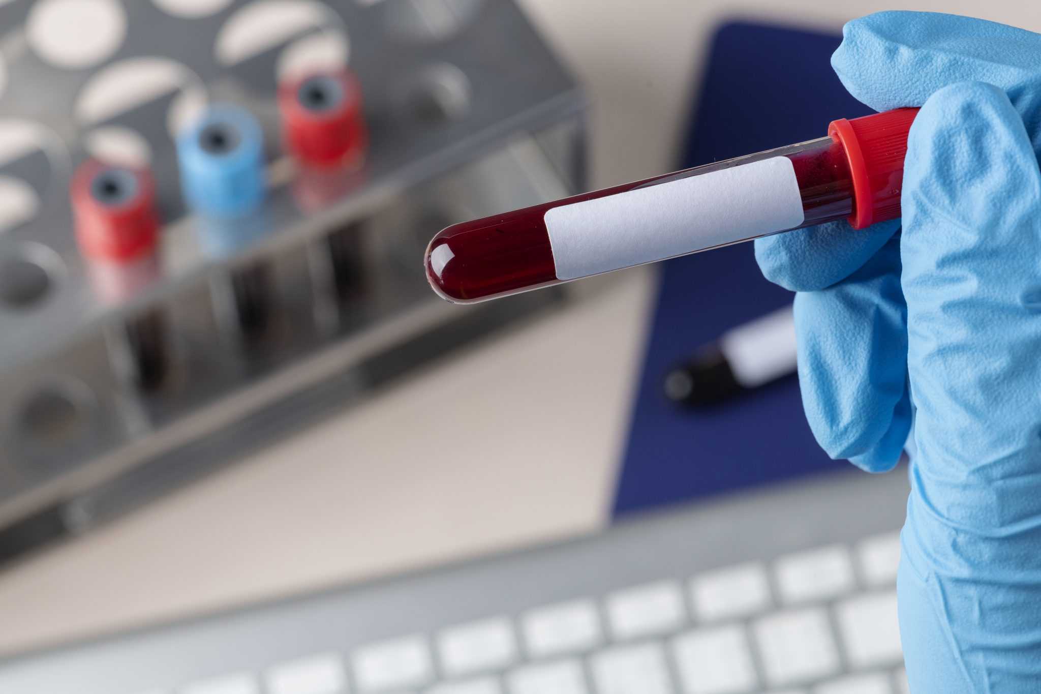 How Testosterone Replacement Therapy Affects Hematocrit Levels: A ...