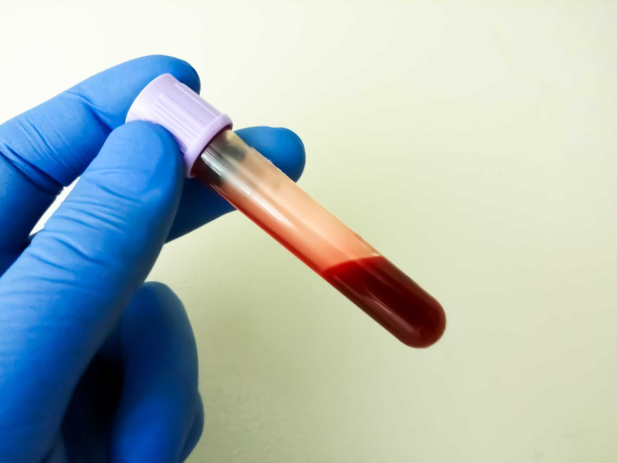 How Testosterone Replacement Therapy Affects Hematocrit Levels: A ...