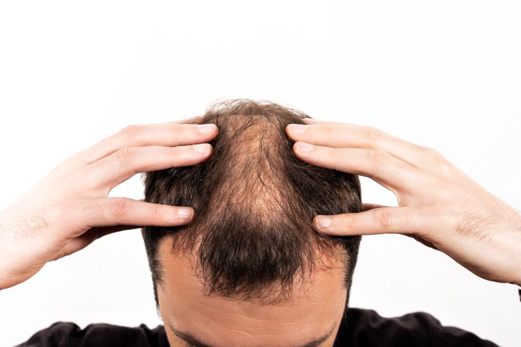 Can You Go Bald from Testosterone Therapy? What Studies Reveal About ...