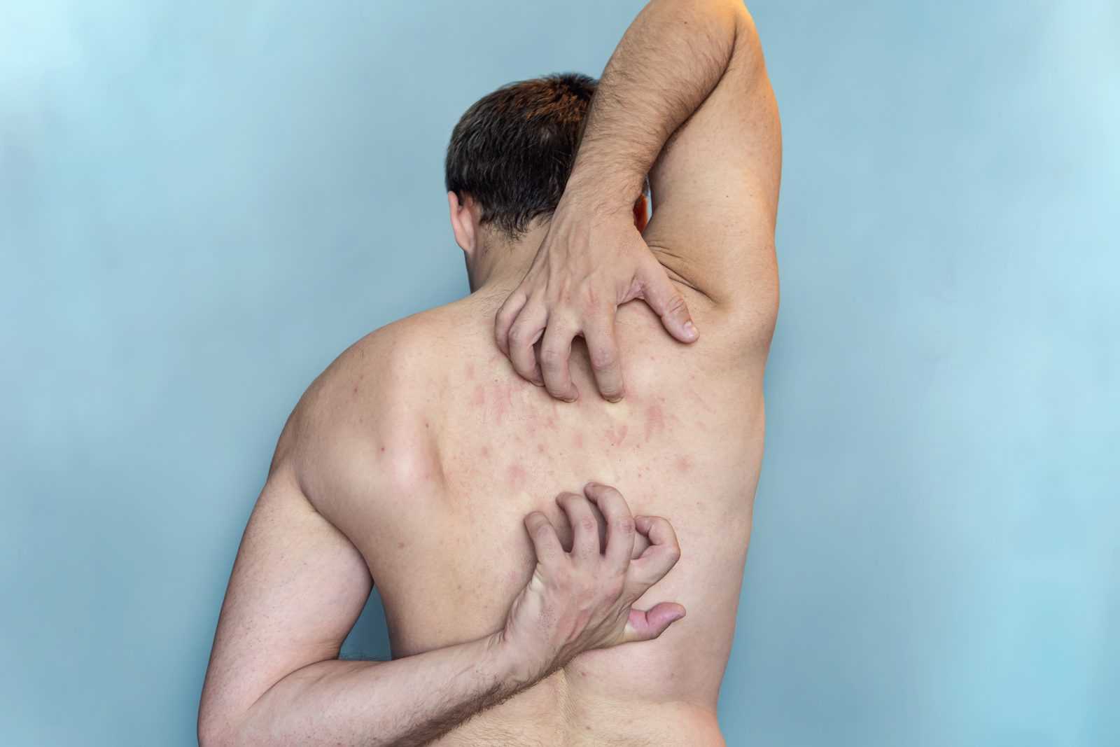 TRT Acne Guide: How Testosterone Replacement Therapy Triggers Back ...