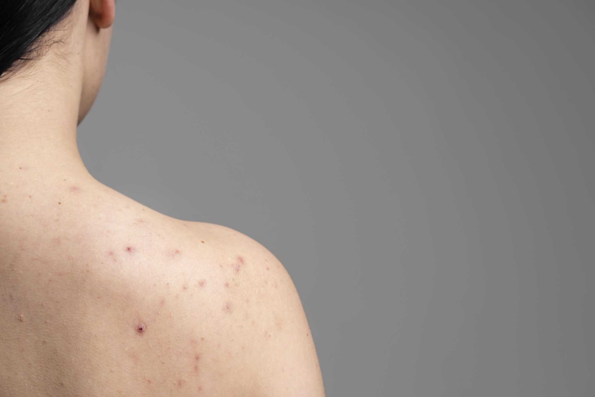 TRT Acne Guide: How Testosterone Replacement Therapy Triggers Back ...