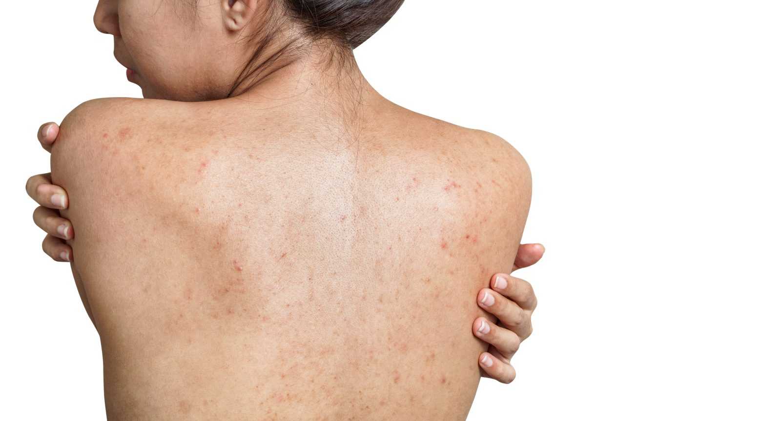 TRT Acne Guide: How Testosterone Replacement Therapy Triggers Back ...